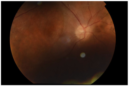 Recurrent Intraocular Lens Dislocation in a Patient with Familial ...