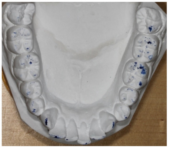 Digital Quantification of Occlusal Contacts: A Methodological Study