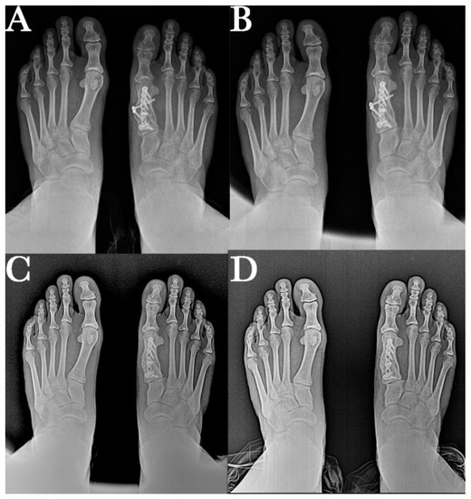 Surgical Reconstruction of Nonunion after Iatrogenic Scarf Osteotomy