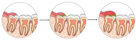 A Review of Evidence-Based Recommendations for Pericoronitis Management ...