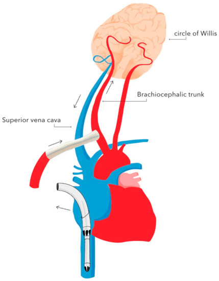 The Role of Deep Hypothermia in Cardiac Surgery