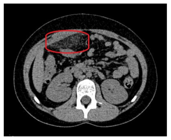 Omental Infarction in a Child—Conservative Management as an Effective ...