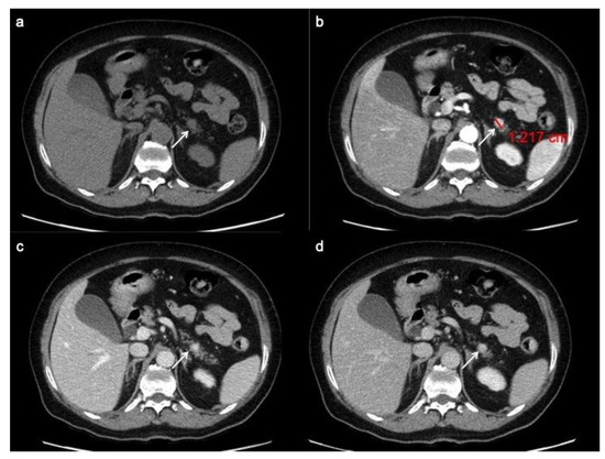 IJERPH | Free Full-Text | Imaging of Pancreatic Neuroendocrine Neoplasms