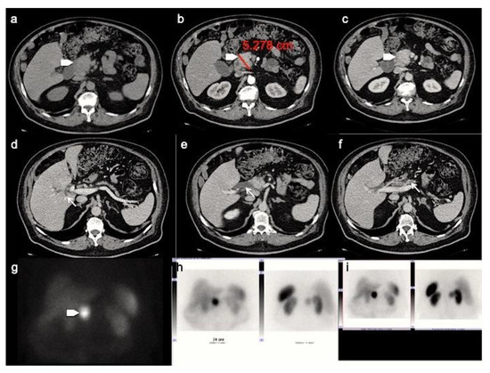IJERPH | Free Full-Text | Imaging of Pancreatic Neuroendocrine Neoplasms