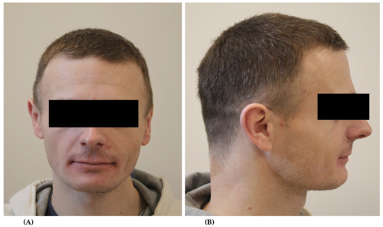 Oral Surgery Procedures in a Patient with Hajdu-Cheney Syndrome Treated ...