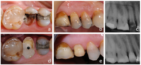 Orthodontic Extrusion vs. Surgical Extrusion to Rehabilitate Severely ...