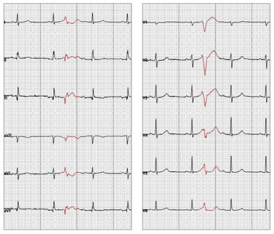 Successful Catheter Ablation of the “R on T” Ventricular Fibrillation