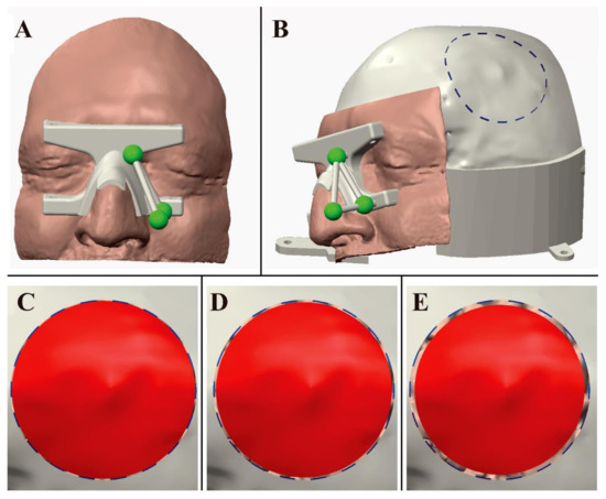 Augmented Reality-Assisted Craniotomy for Parasagittal and Convexity En ...