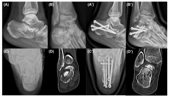 Surgical Treatment Using Sinus Tarsi Approach with Anterolateral ...