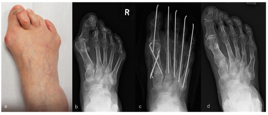 Forefoot Deformities in Patients with Rheumatoid Arthritis: Mid- to Long-Term Result of Joint ...