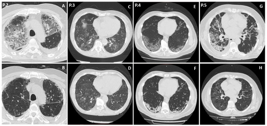 Pneumocystis jirovecii Pneumonia in Non-HIV Patients Recovering from ...