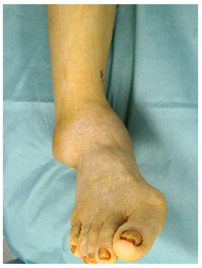 Staged Joint Arthrodesis in the Treatment of Severe Septic Ankle ...