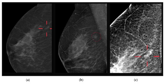 Diabetic Mastopathy. Review of Diagnostic Methods and Therapeutic Options