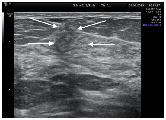 Diabetic Mastopathy. Review of Diagnostic Methods and Therapeutic Options