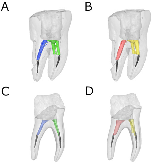 Comparative Analysis of Ease of Removal of Fractured NiTi Endodontic ...