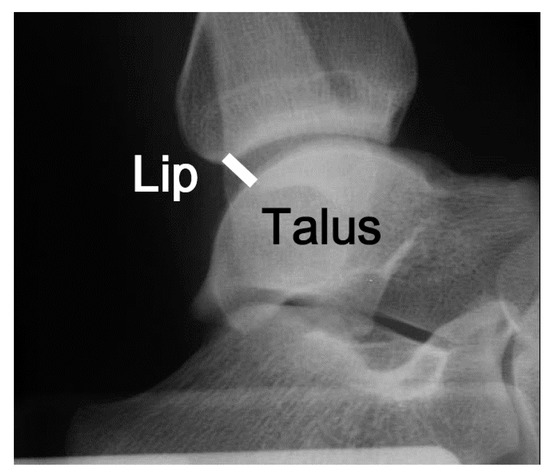 Feasibility of an Ultrasound-Based Method for Measuring Talar ...
