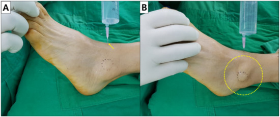 Clinical Manifestations, Diagnosis and Management of Synovial Fistula ...