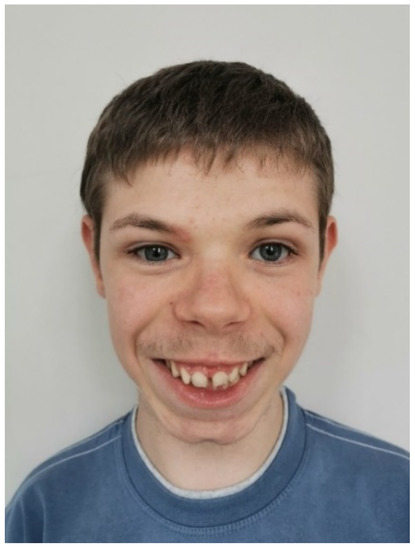 Patient With Phenylketonuria And Intellectual Disability Problem Not