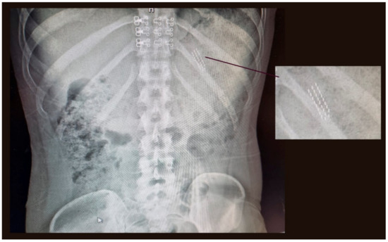 Accidentally Swallowing a Toothbrush in a Patient during a Vomiting ...