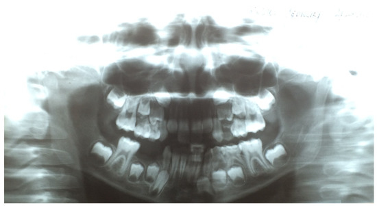 IJERPH | Free Full-Text | Symptoms of the Eruption of Permanent Teeth