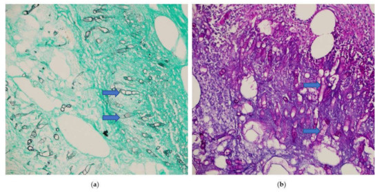 A Very Rare Basidiobolomycosis Case Presented with Cecal Perforation ...