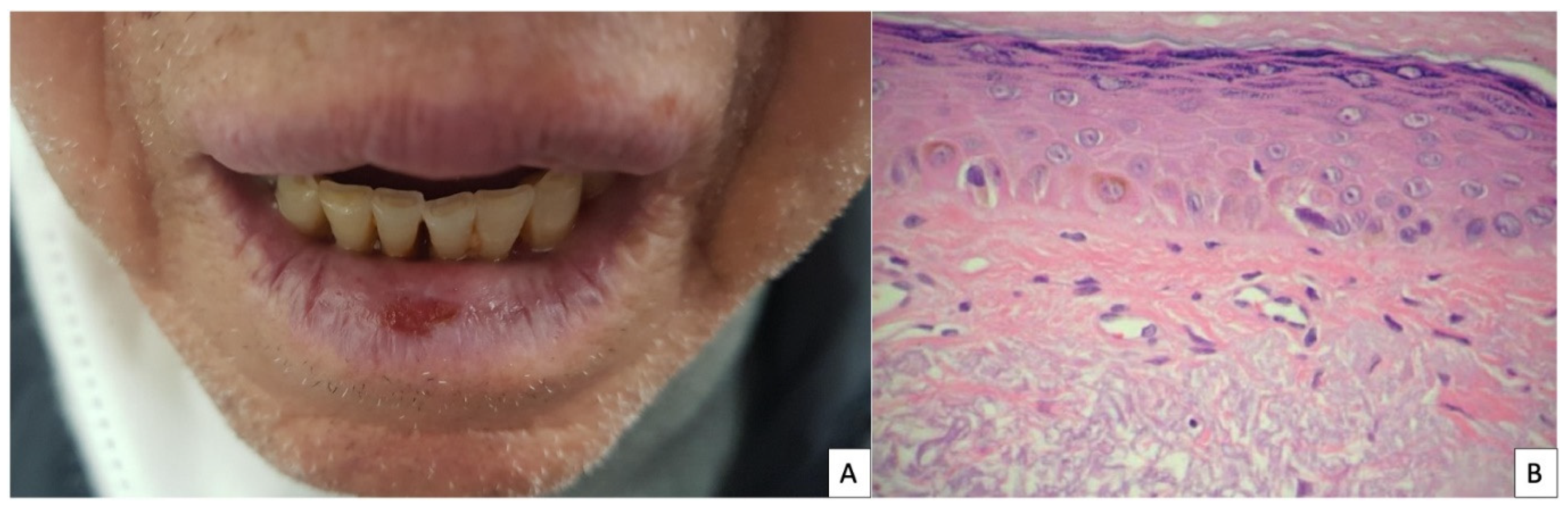 Ijerph Free Full Text Laser Therapy For The Treatment Of Actinic Cheilitis A Systematic Review
