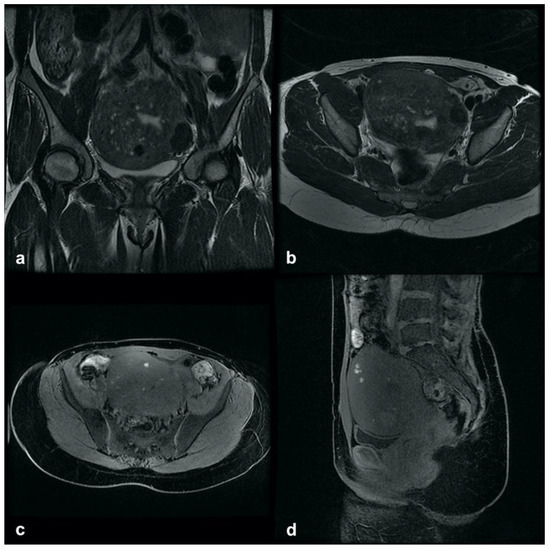 MRI and Adenomyosis: What Can Radiologists Evaluate?