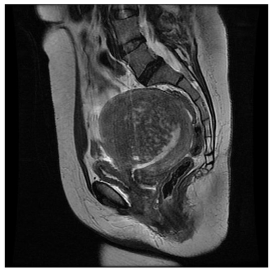 MRI and Adenomyosis: What Can Radiologists Evaluate?