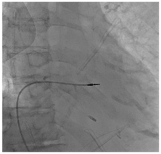 IJERPH | Free Full-Text | Implantation of a Leadless Pacemaker after ...