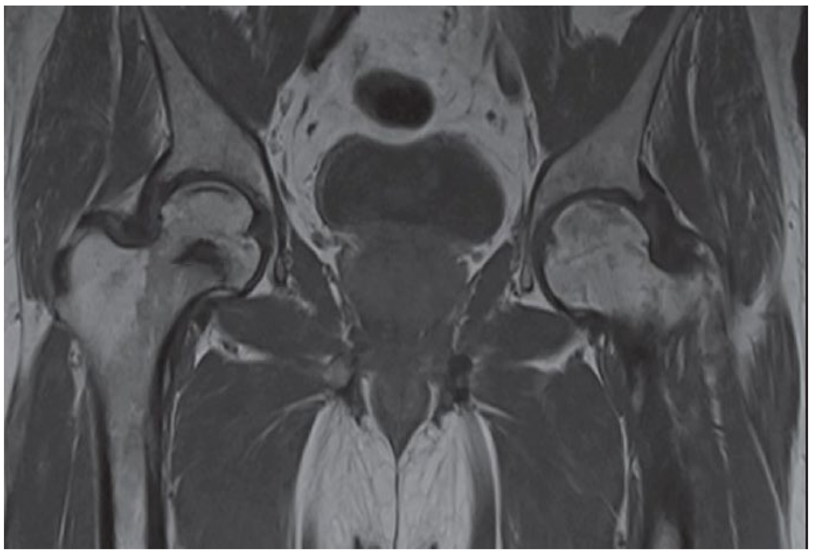 Avascular Necrosis Of Femoral Head Mri
