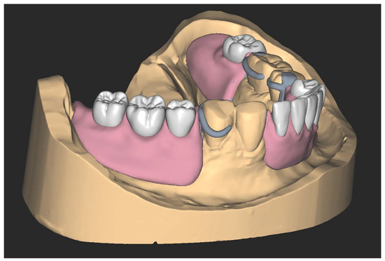 A Digital Workflow for the Fabrication of a Milled Removable Partial ...