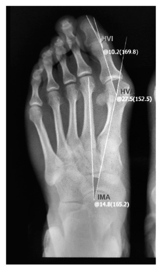 Development of a Manual Measurement Device for Measuring Hallux Valgus ...