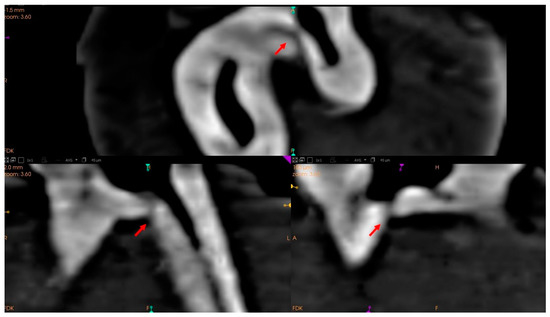 Three-Dimensional Analysis of the Pulp Chamber and Coronal Tooth of ...