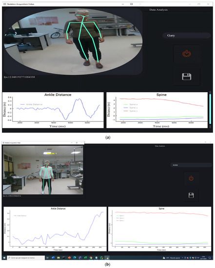SANE (Easy Gait Analysis System): Towards an AI-Assisted Automatic Gait-Analysis