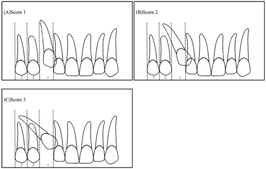 Severity and Treatment Difficulty of Impacted Maxillary Canine among ...