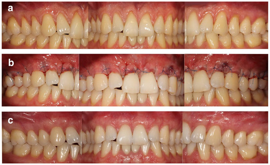Clinical and Aesthetic Outcomes of Multiple Gingival Recessions ...