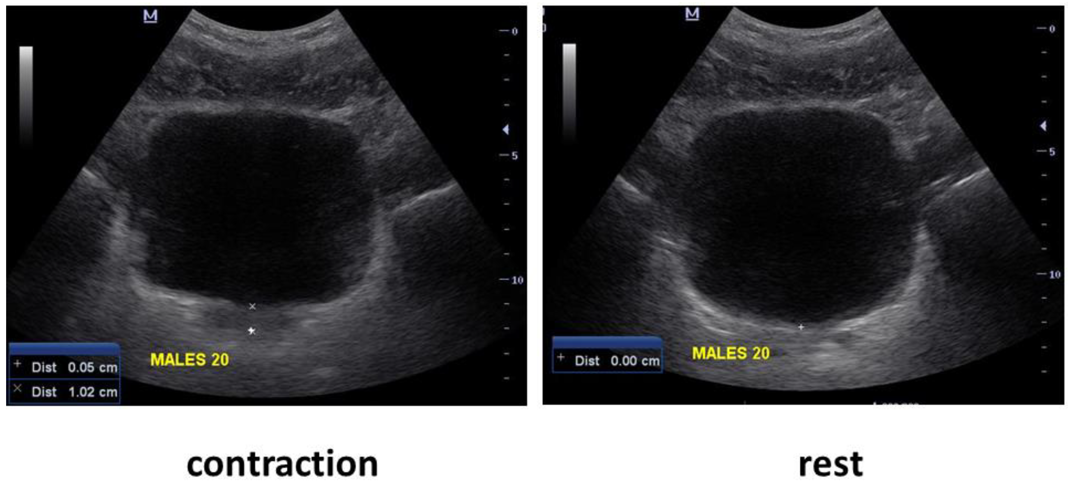 Verbal Instruction for Pelvic Floor Muscle Contraction among Healthy ...