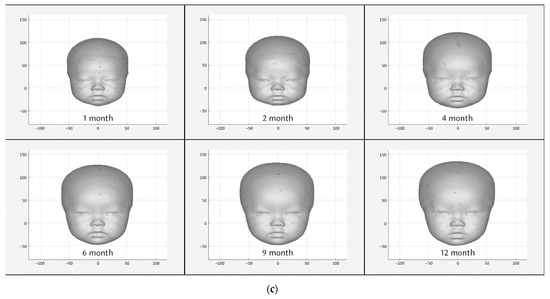 Craniofacial Growth and Asymmetry in Newborns: A Longitudinal 3D Assessment