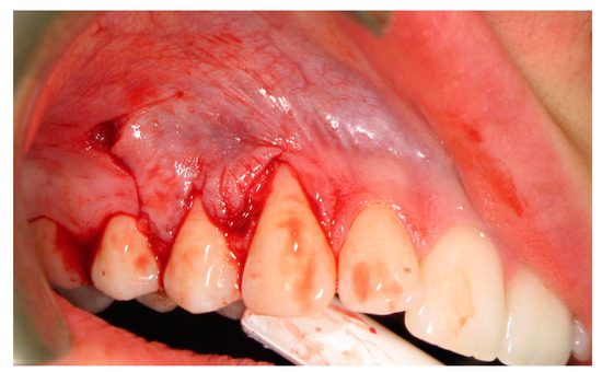 IJERPH | Free Full-Text | Laterally Positioned Flap Procedure with ...