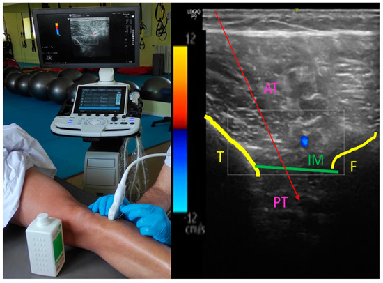 IJERPH | Free Full-Text | Effect of Dry Needling Treatment on Tibial ...