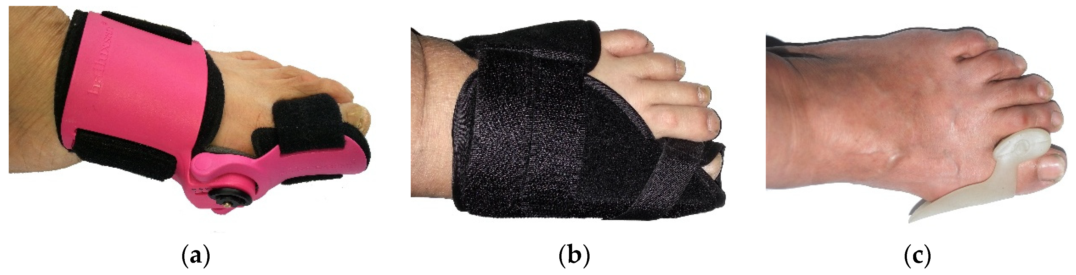 The Evaluation of Orthotics in Reducing Hallux Valgus Angle in Patients with Hallux Valgus over ...