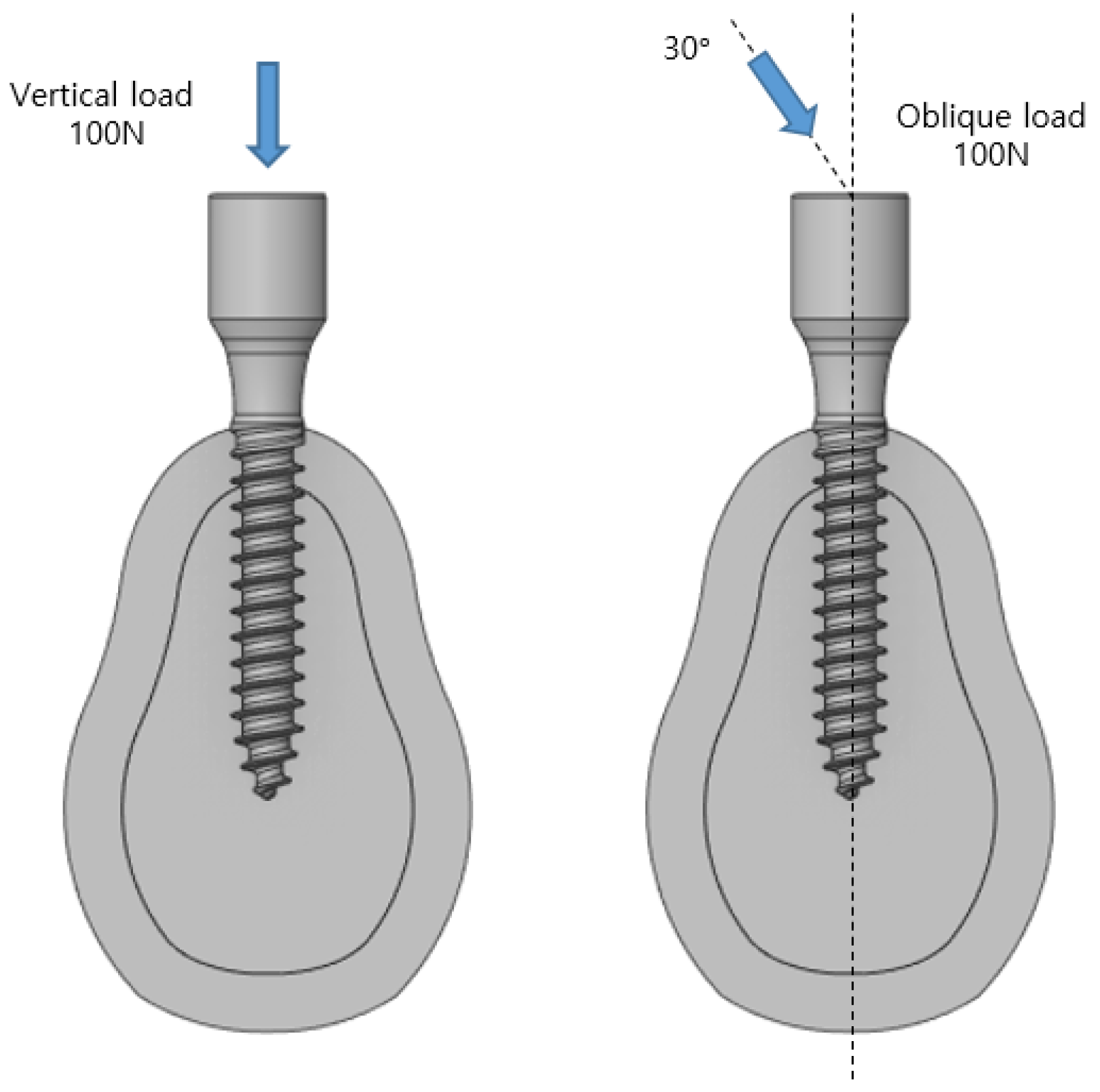 Stress Distribution Analysis of Threaded Implants for Digital Dentistry