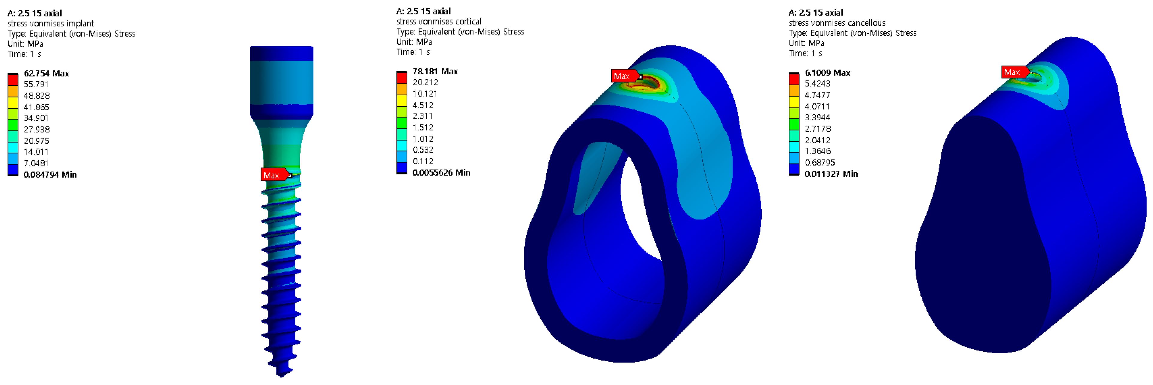 Stress Distribution Analysis of Threaded Implants for Digital Dentistry