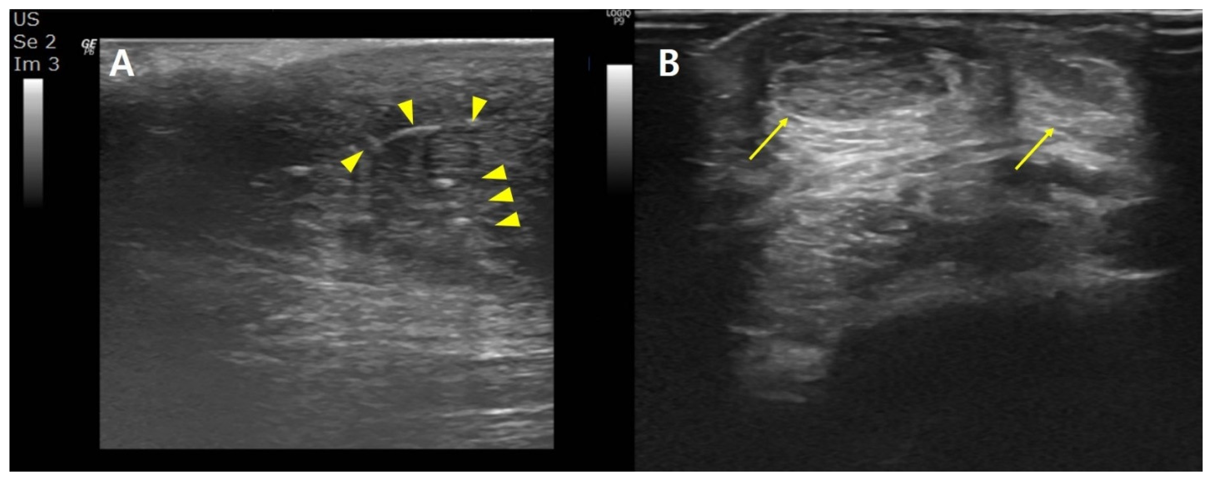 Clinical Features and Treatment of Intra-Tendinous Suture Reaction ...