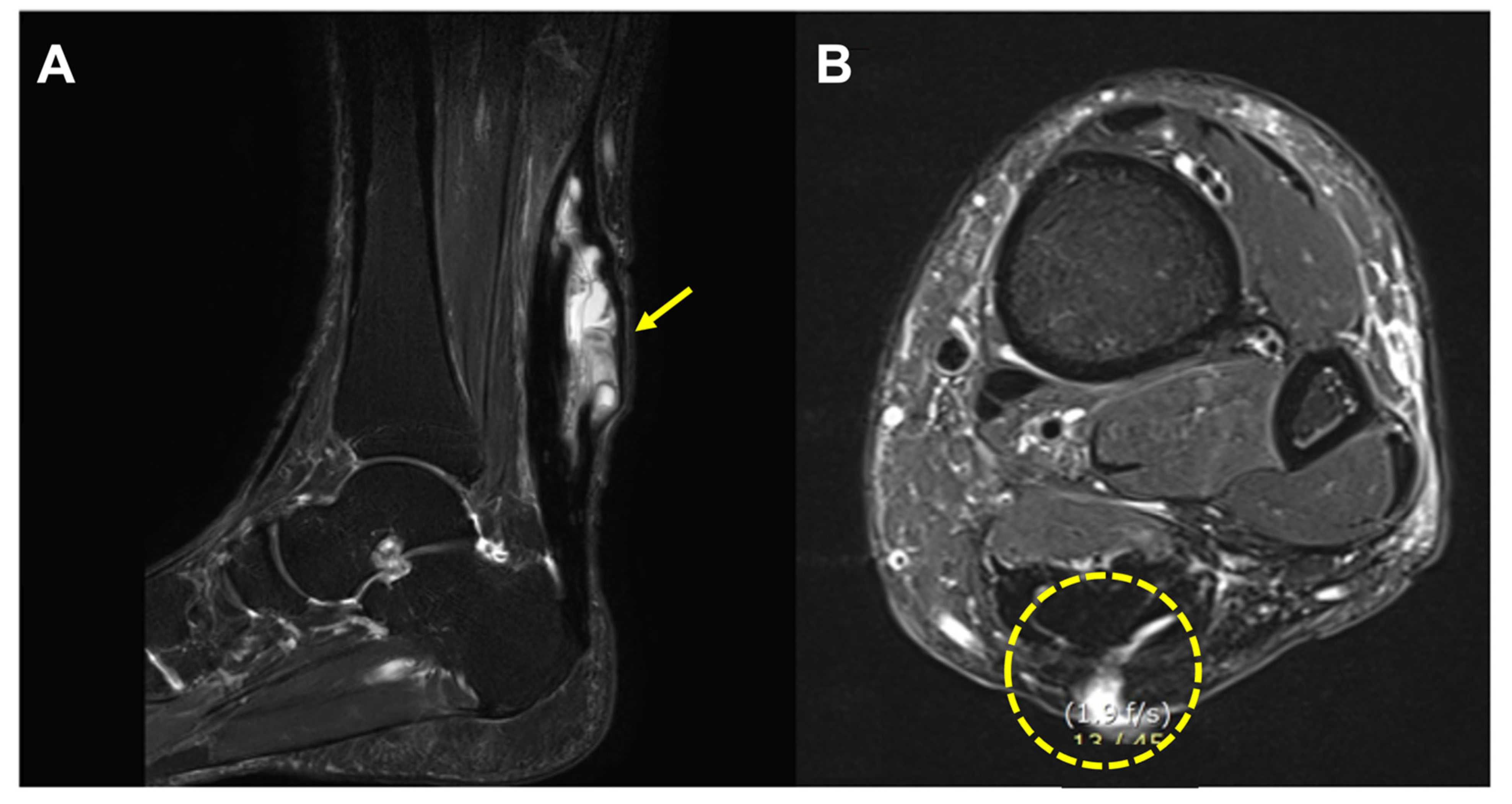 Clinical Features and Treatment of Intra-Tendinous Suture Reaction ...