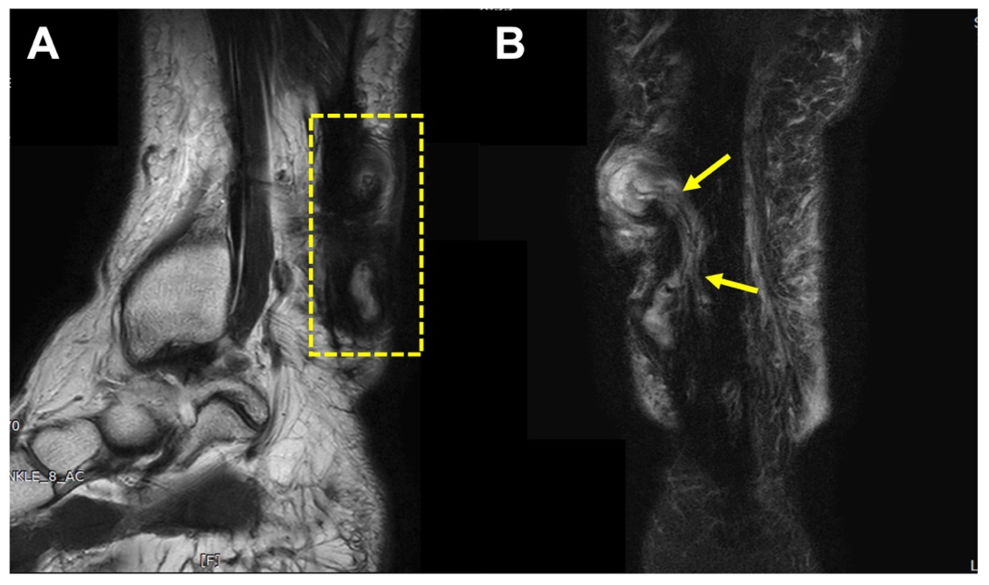 Clinical Features and Treatment of Intra-Tendinous Suture Reaction ...