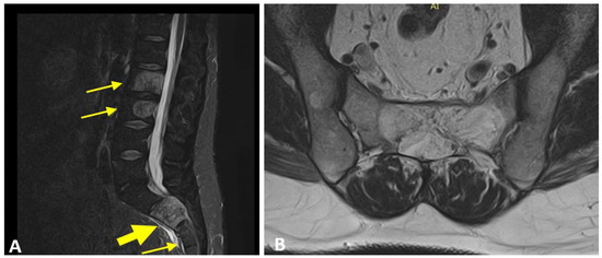 Aggressive Vertebral Hemangioma and Spinal Cord Compression: A ...