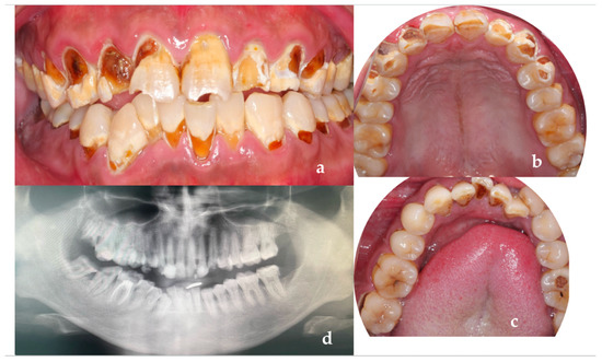 Application of a Caries Treatment Difficulty Assessment System in ...