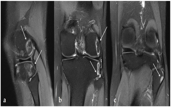 MRI Bone Abnormality of the Knee following Ultrasound Therapy: Case Report and Short Review