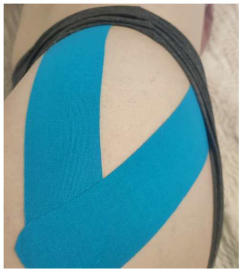 Ijerph Free Full Text Effects Of Kinesio Taping And Rigid Taping On